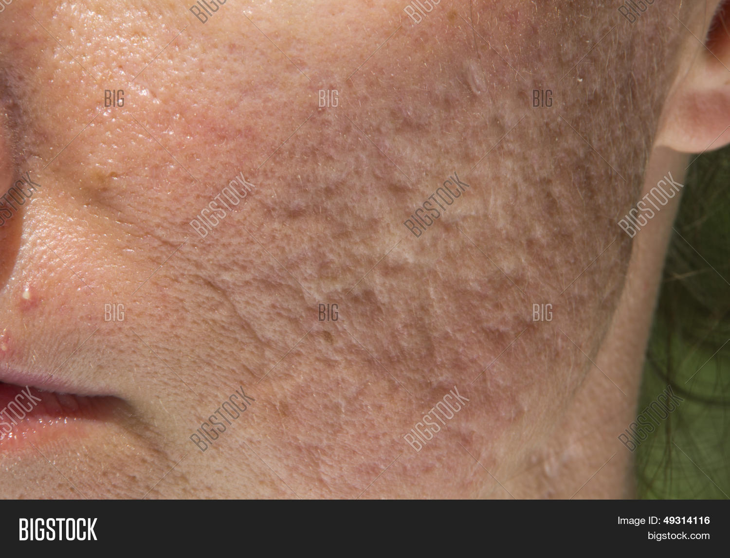 Pimple Acne Scars Image & Photo (Free Trial) | Bigstock