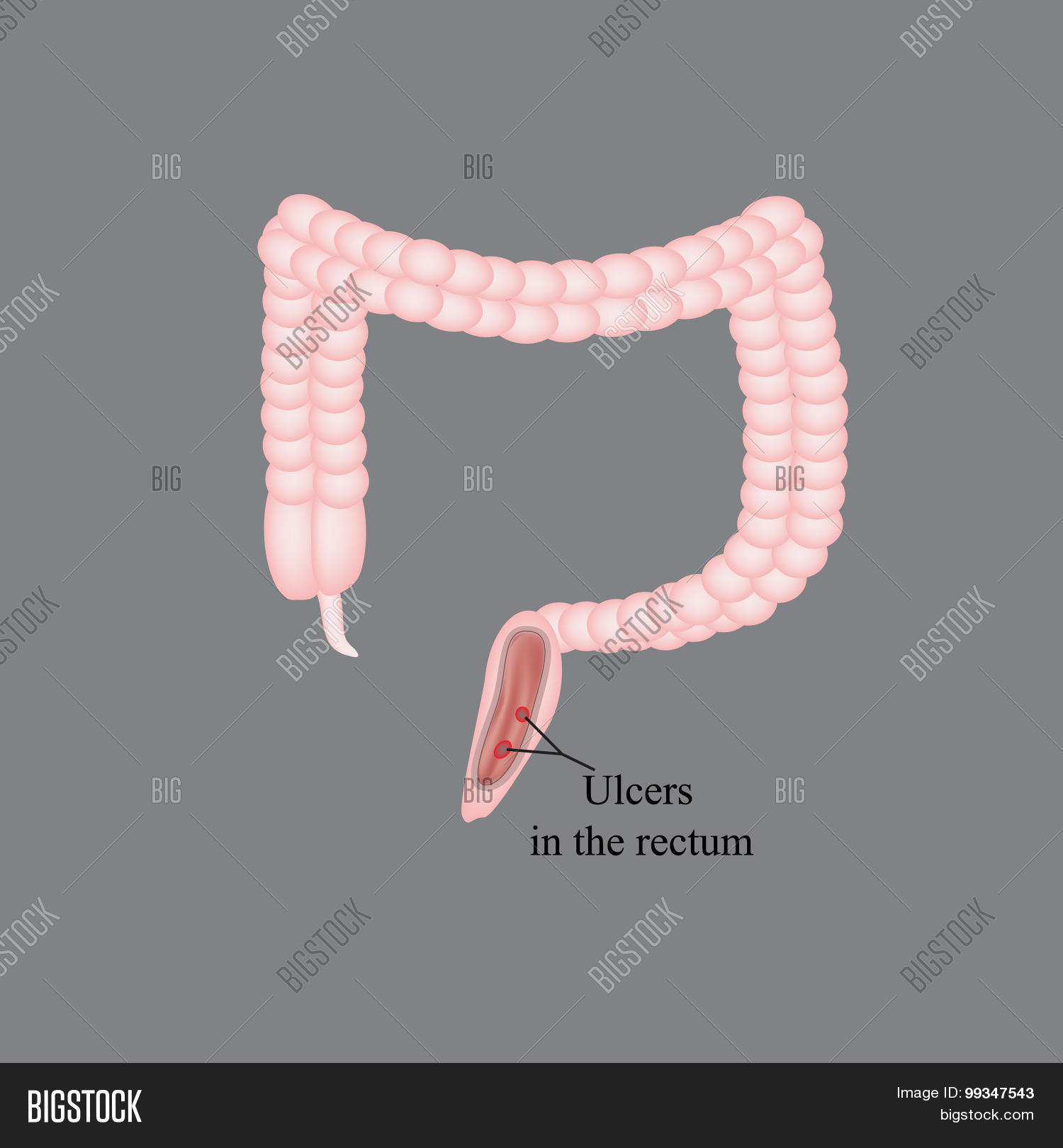 Ulcer Rectum. Ulcers Vector & Photo (Free Trial) | Bigstock