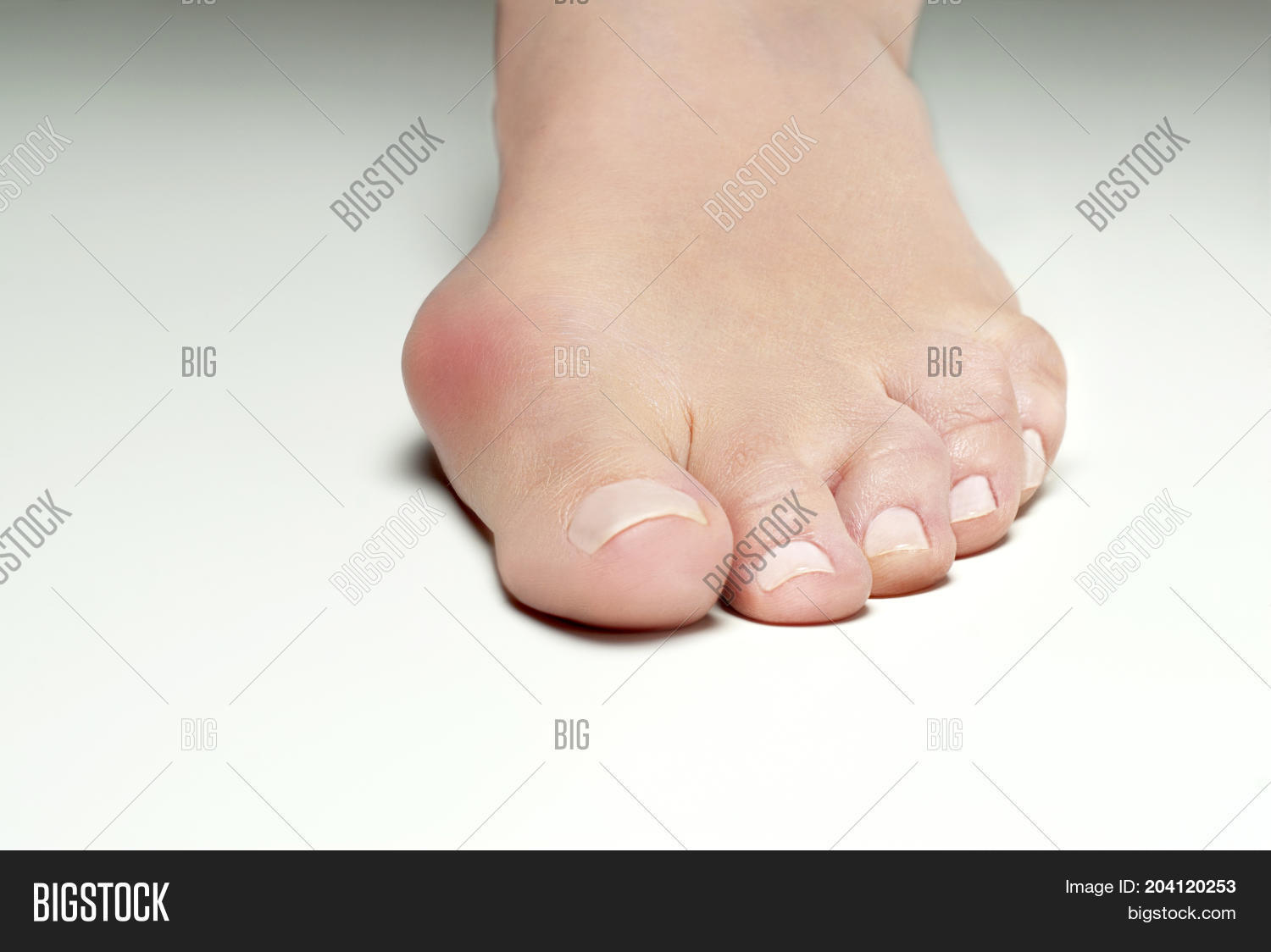 Hallux Valgus, Bunion Image & Photo (Free Trial) | Bigstock