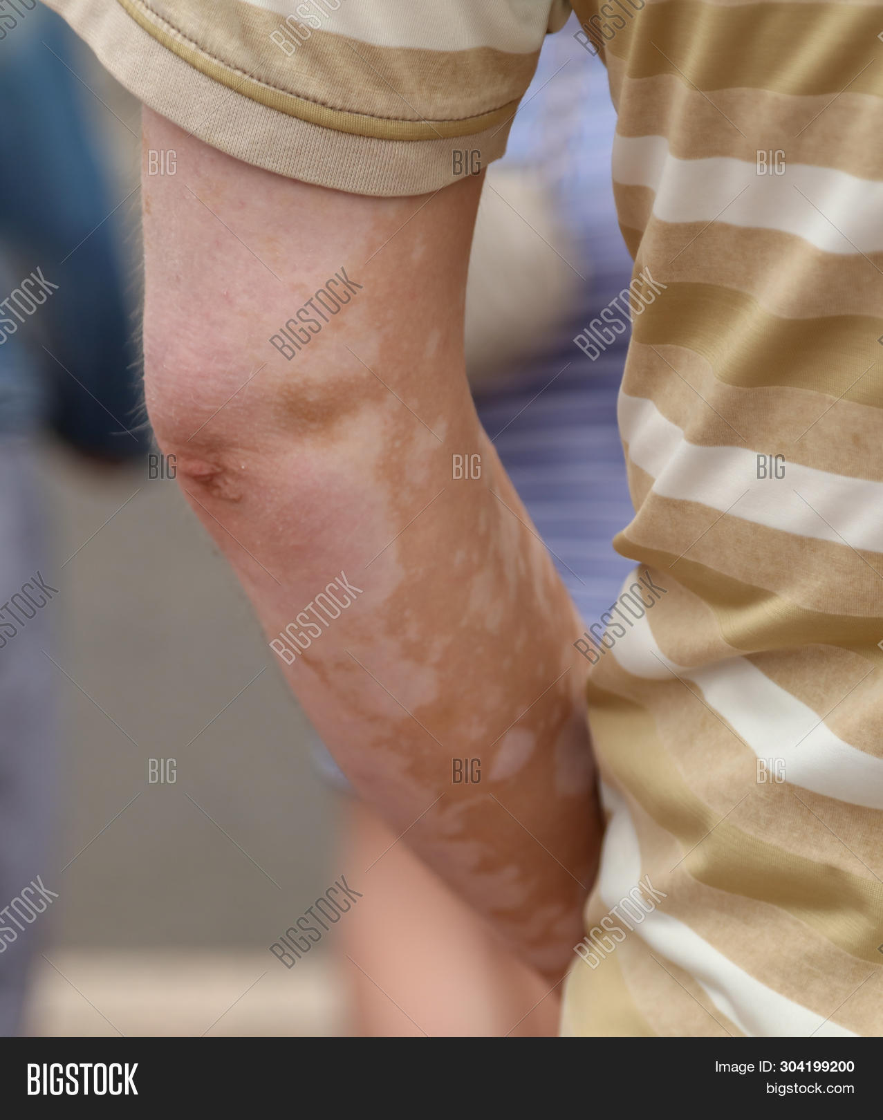 Eczema On Skin Hand . Image & Photo (Free Trial) | Bigstock