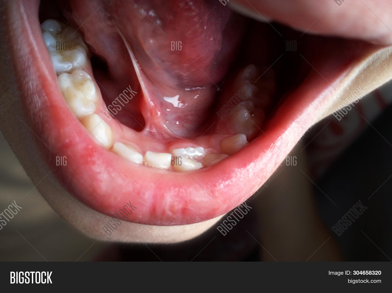 Permanent Tooth Adult Image & Photo (Free Trial) | Bigstock