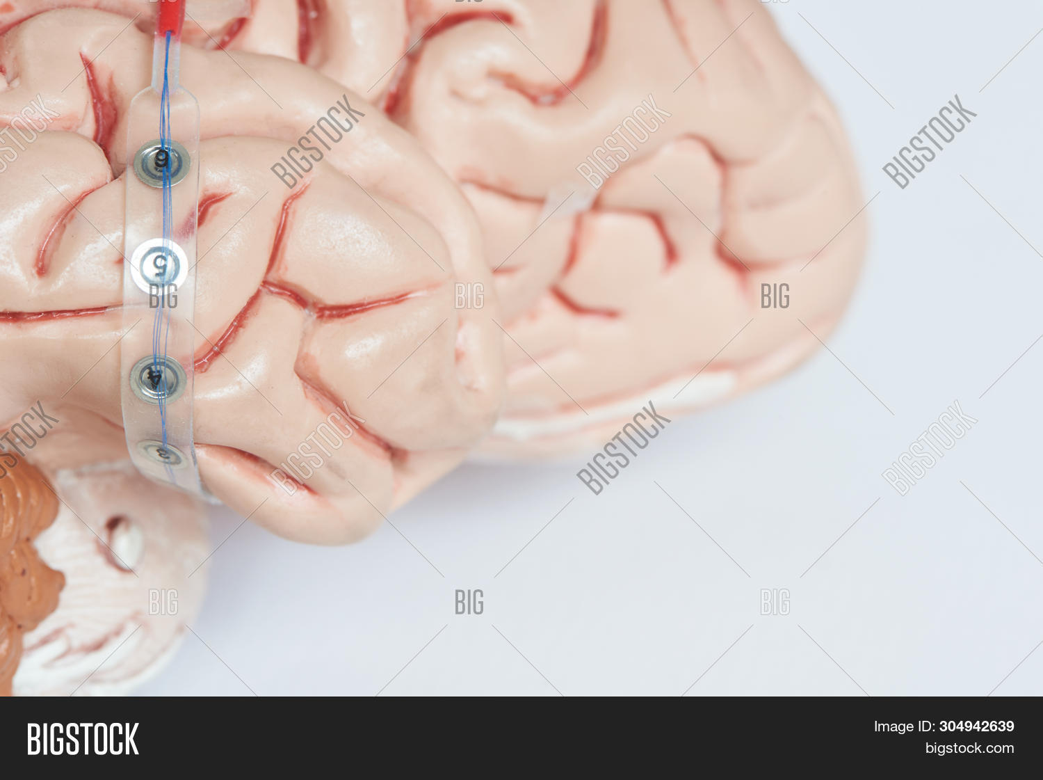 Subdural Grid Image & Photo (Free Trial) | Bigstock