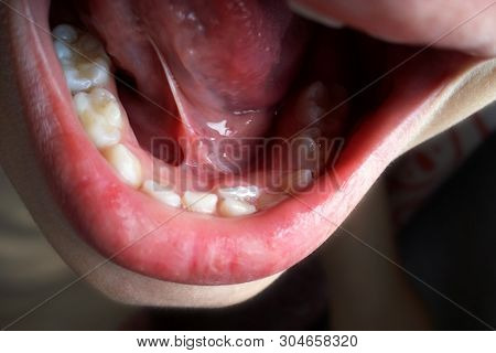 Permanent Tooth Adult Image & Photo (Free Trial) | Bigstock