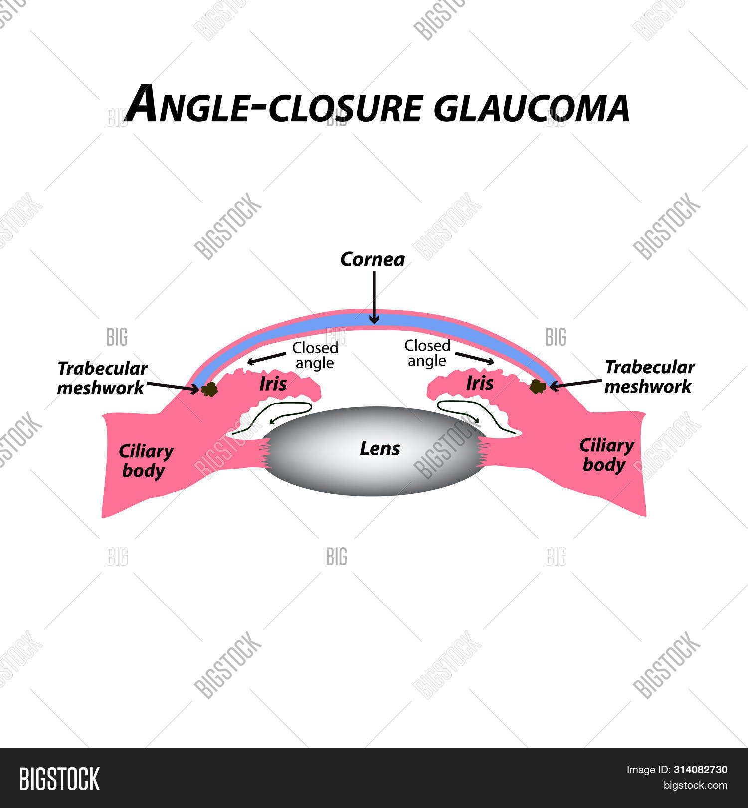 Closed Angle Glaucoma Image & Photo (Free Trial) | Bigstock