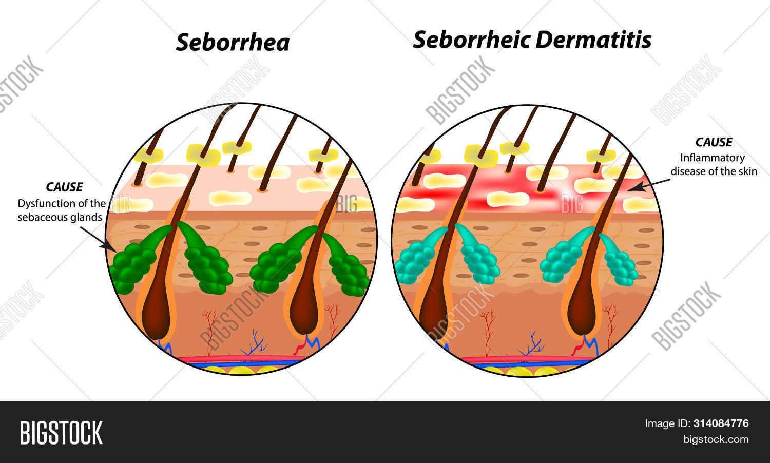 Causes Seborrhea Skin Image & Photo (Free Trial) | Bigstock