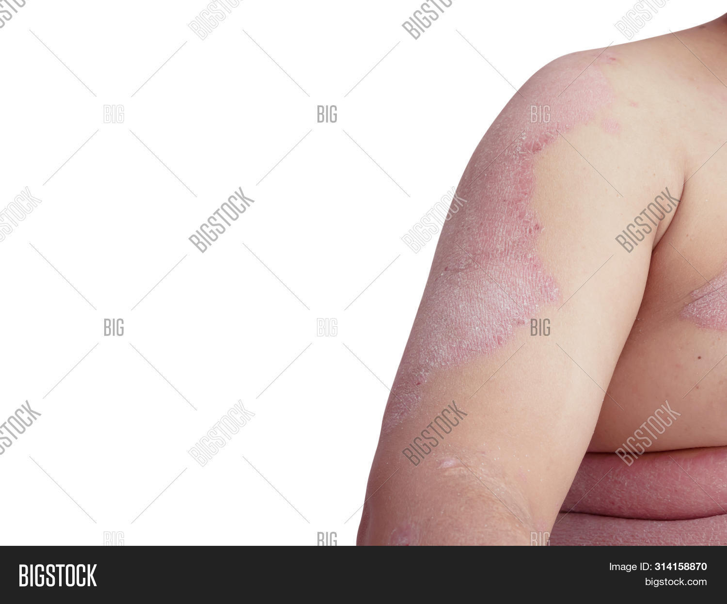 Close Shoulder Ulcers Image & Photo (Free Trial) | Bigstock