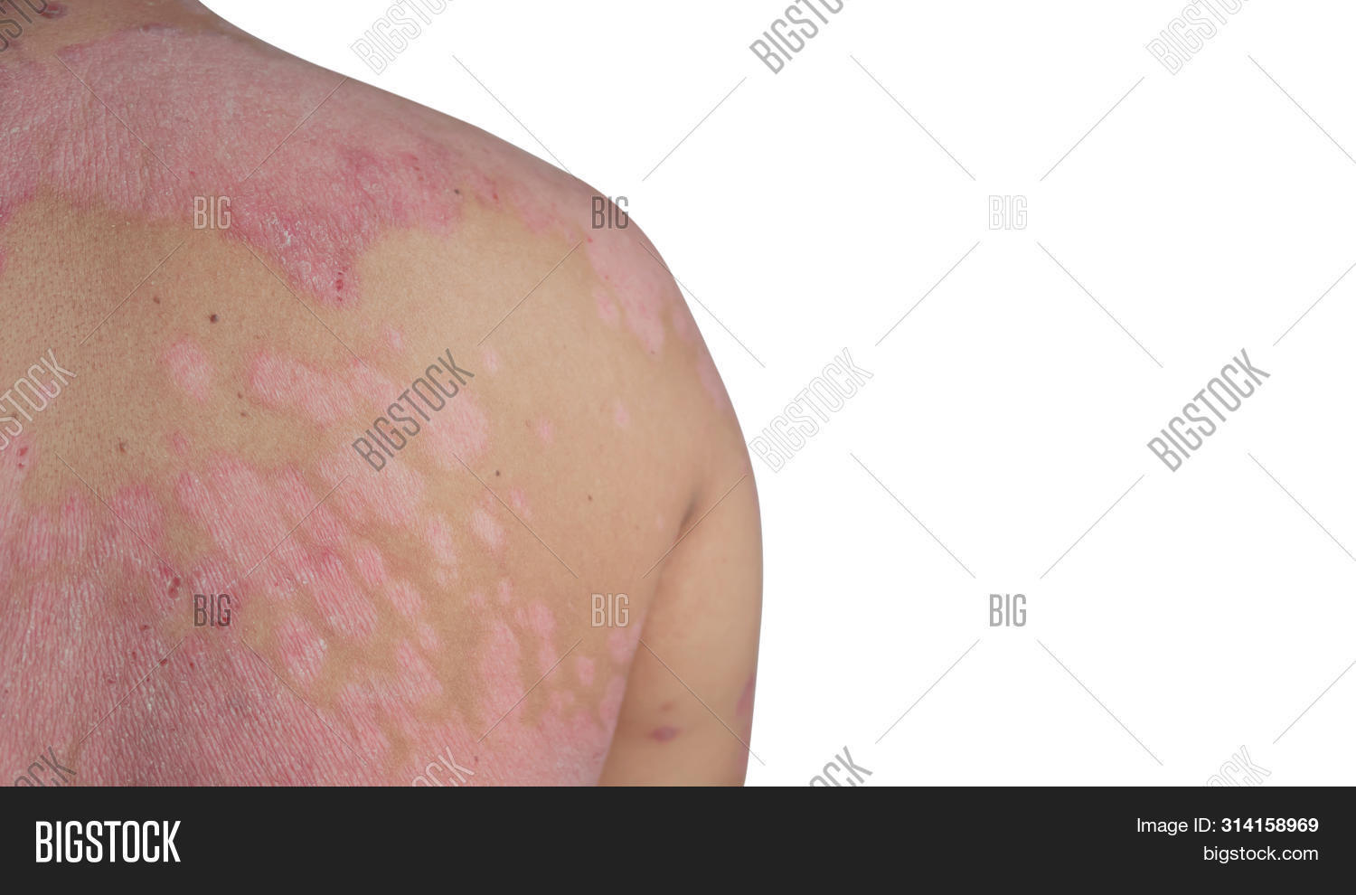 Close Shoulder Ulcers Image & Photo (Free Trial) | Bigstock