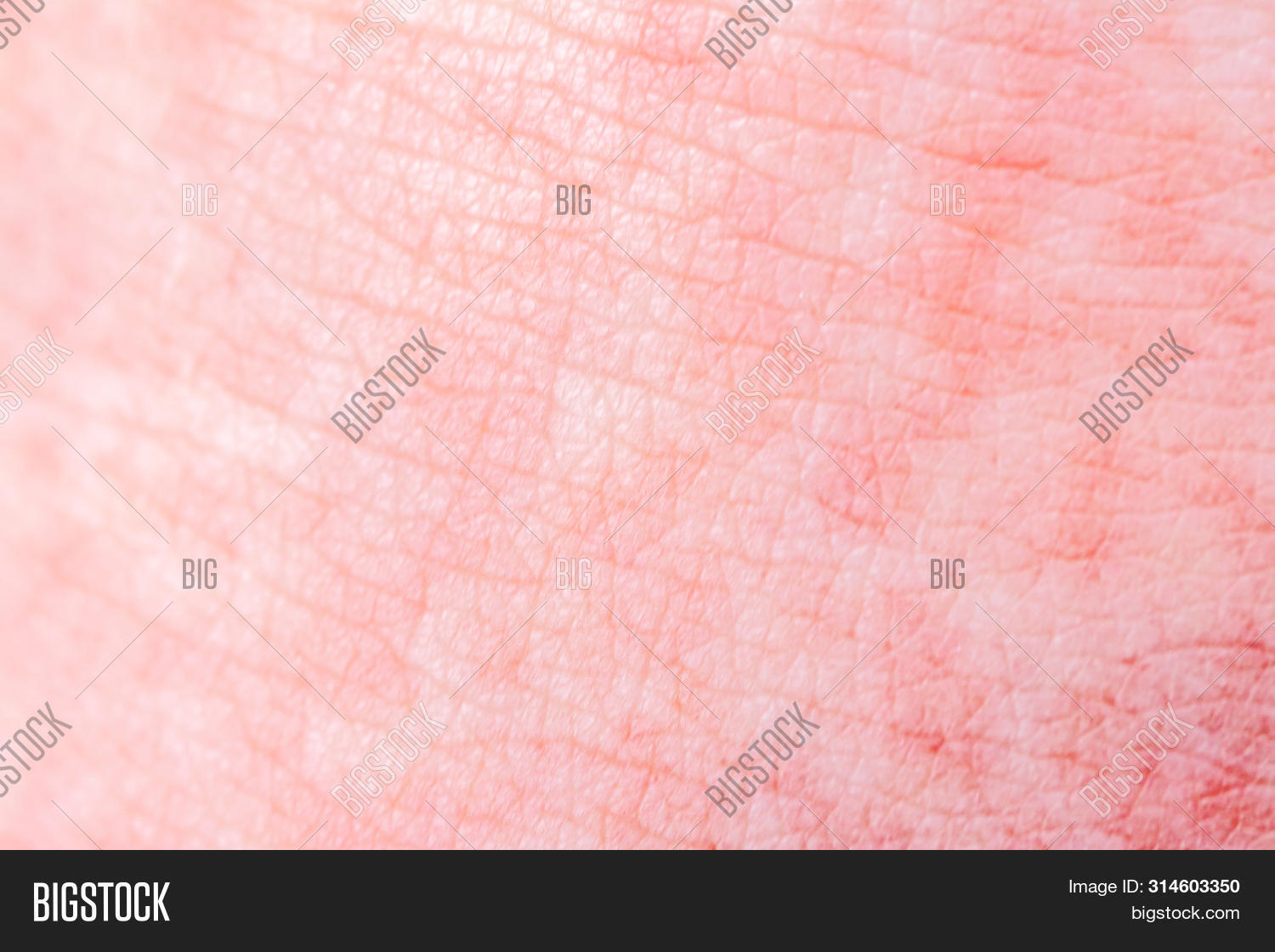 Imagen y foto Scarlet Fever (prueba gratis) | Bigstock