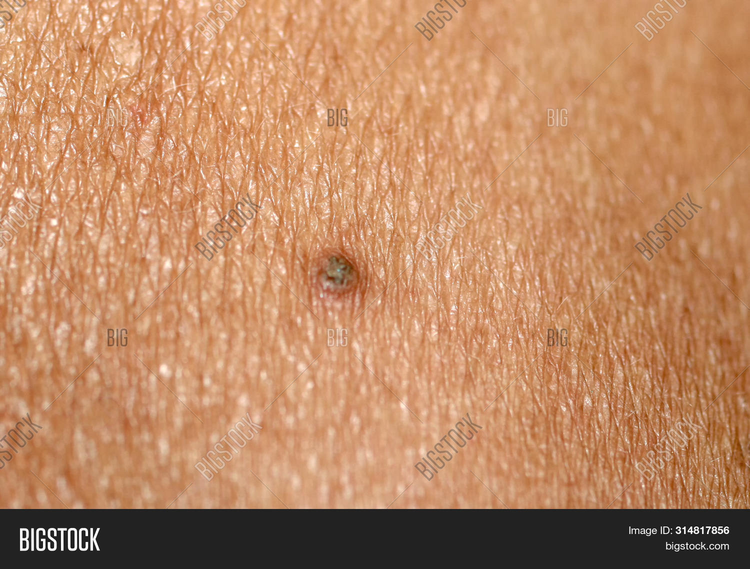 Burn On Skin. Blister Image & Photo (Free Trial) | Bigstock