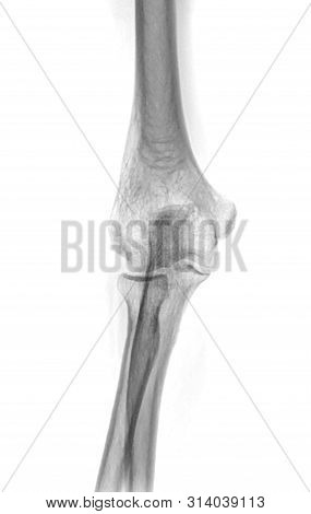 X-ray Elbow Image & Photo (Free Trial) | Bigstock