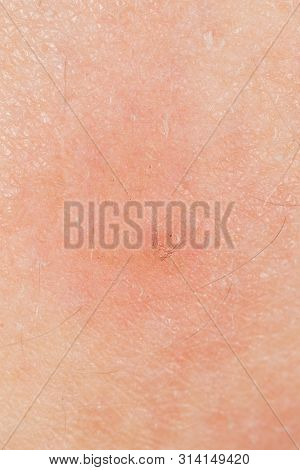 Little Wound On Human Image & Photo (Free Trial) | Bigstock
