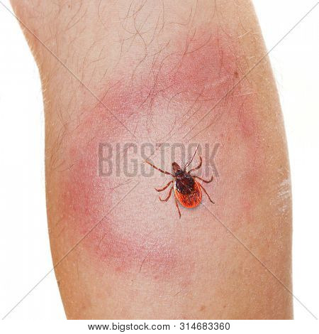 Erythema Migrans Rash Image & Photo (Free Trial) | Bigstock
