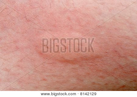 Bug Allergy Pimple Image & Photo (Free Trial) | Bigstock
