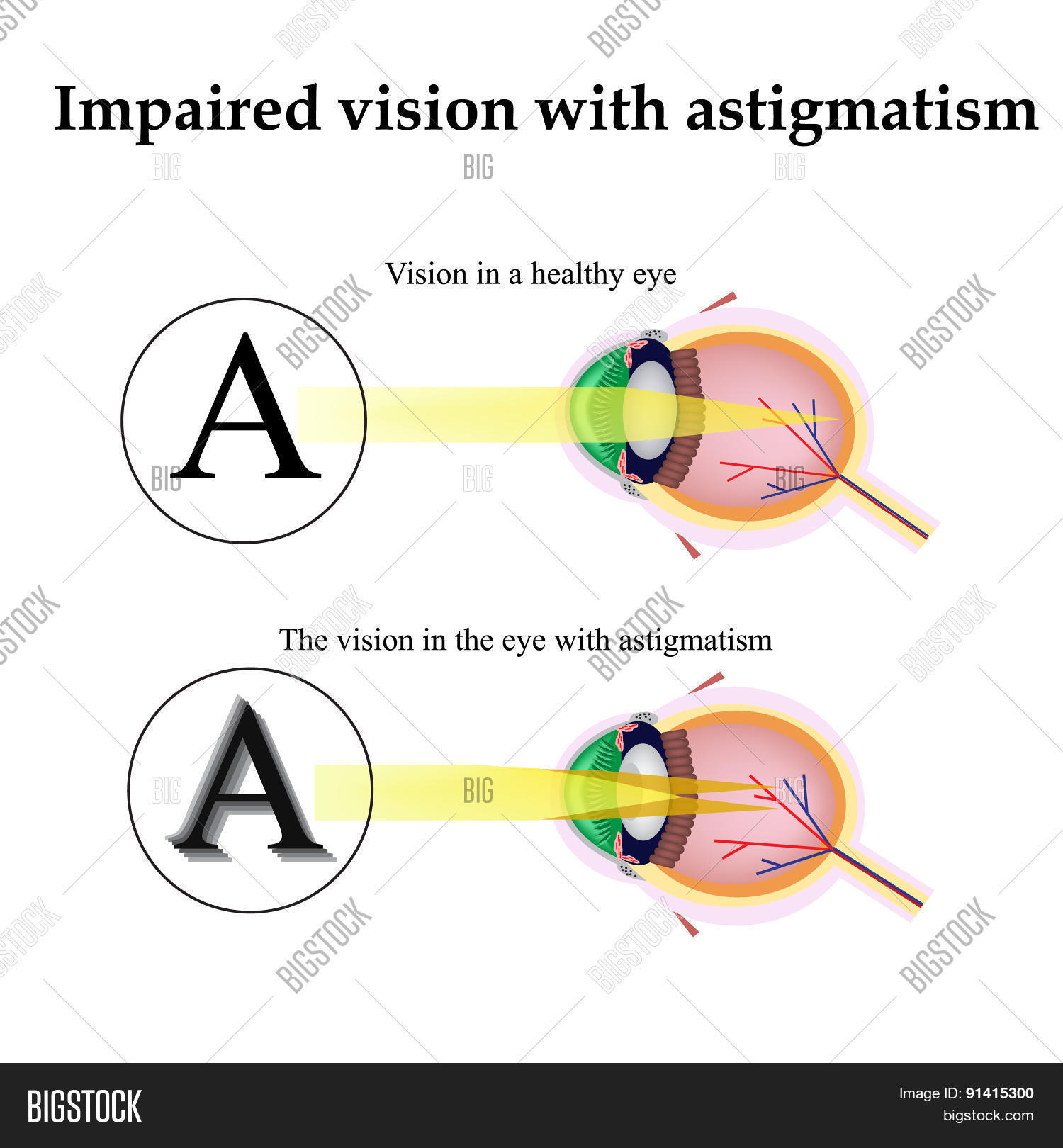 Astigmatism. Eye Can Vector & Photo (Free Trial) | Bigstock