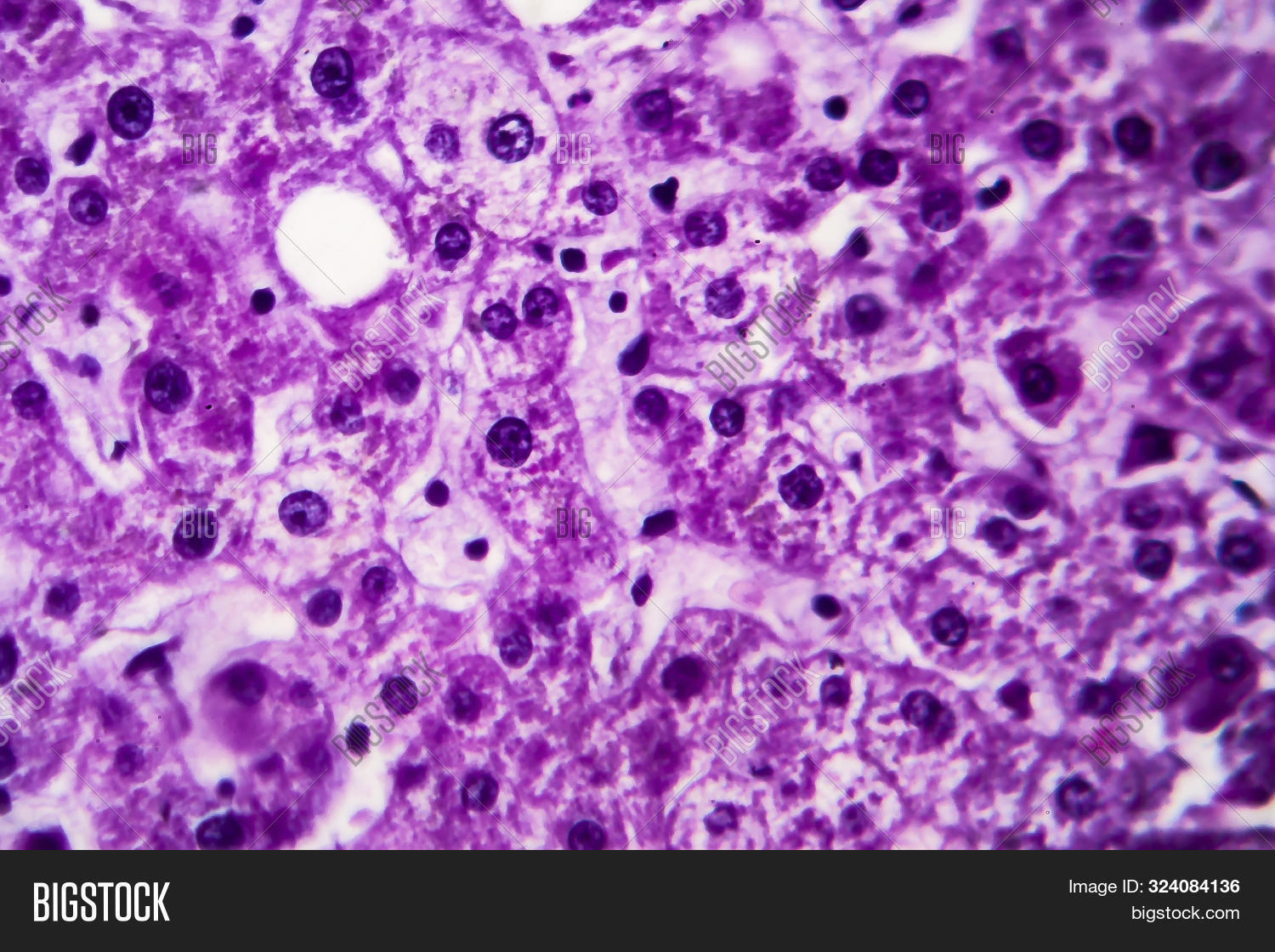 Cloudy Swelling Liver Image & Photo (Free Trial) | Bigstock