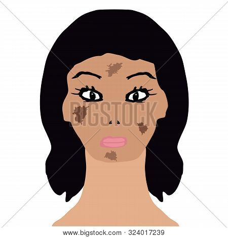 Melasma Images, Illustrations & Vectors (Free) - Bigstock
