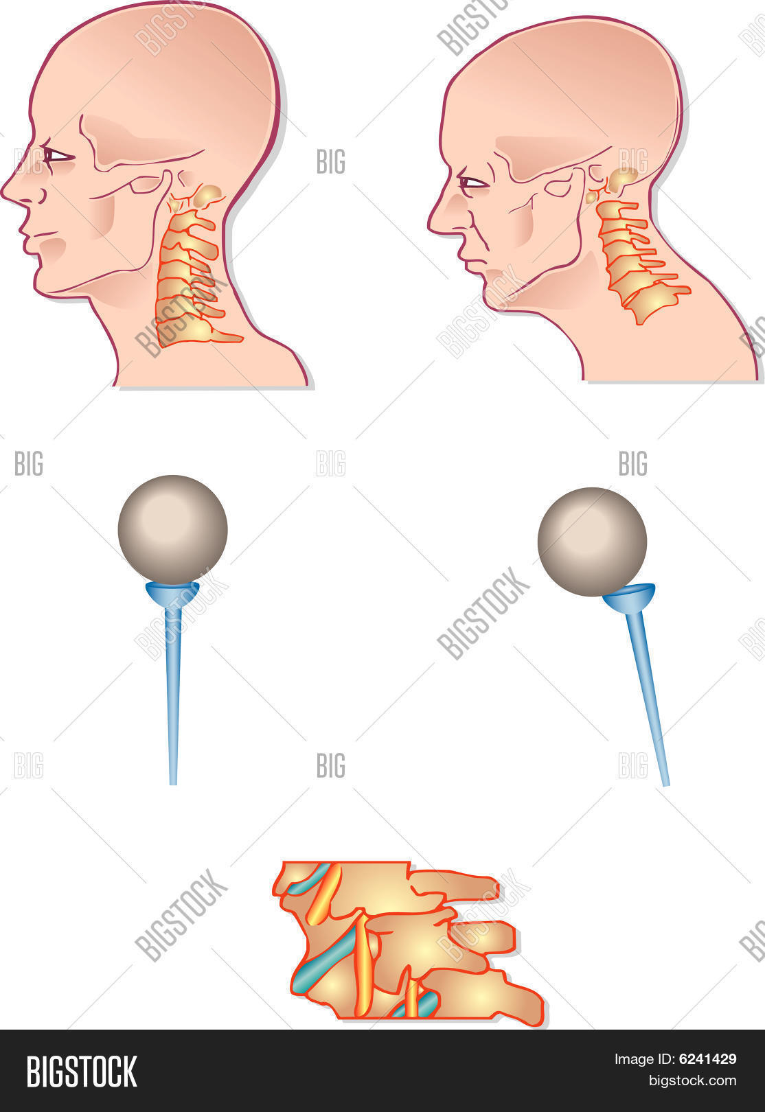 Neck Spine Condition Vector & Photo (Free Trial) | Bigstock