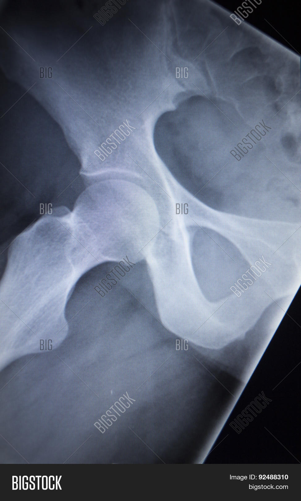 X-ray Orthopedic Scan Image & Photo (Free Trial) | Bigstock