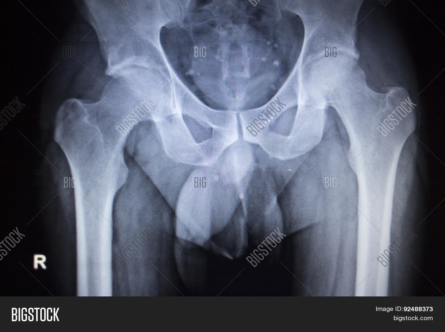 X-ray Orthopedic Scan Image & Photo (Free Trial) | Bigstock
