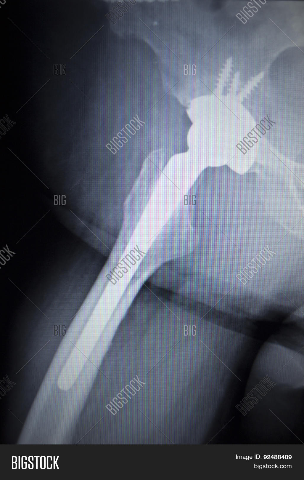 X-ray Scan Image Hip Image & Photo (Free Trial) | Bigstock