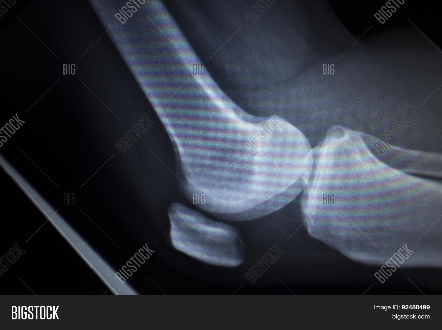 X-ray Orthopedics Scan Image & Photo (Free Trial) | Bigstock