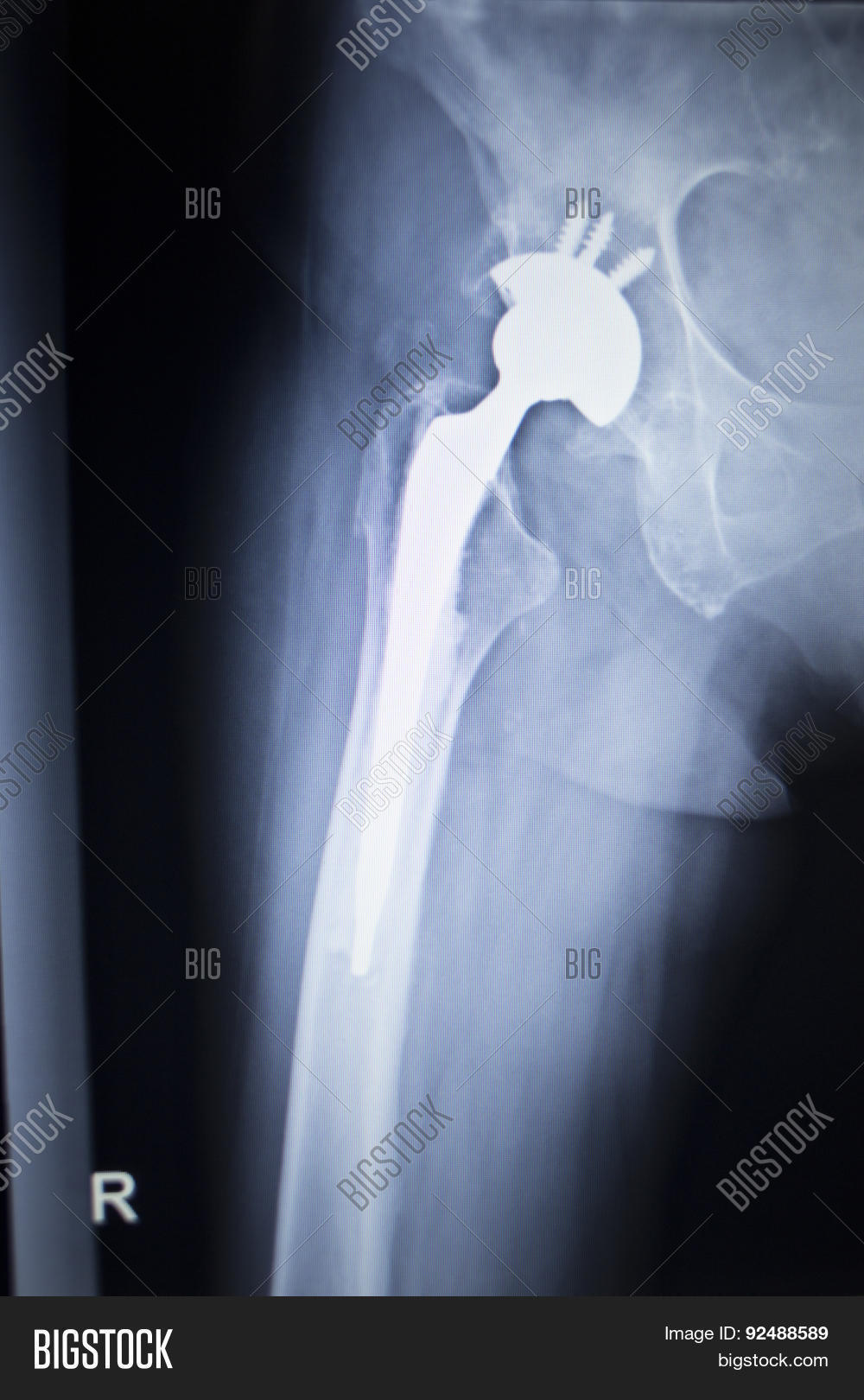X-ray Scan Image Hip Image & Photo (Free Trial) | Bigstock