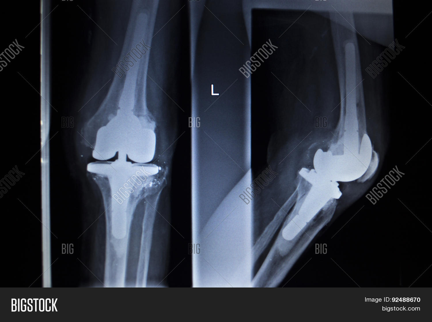 X-ray Orthopedics Scan Image & Photo (Free Trial) | Bigstock