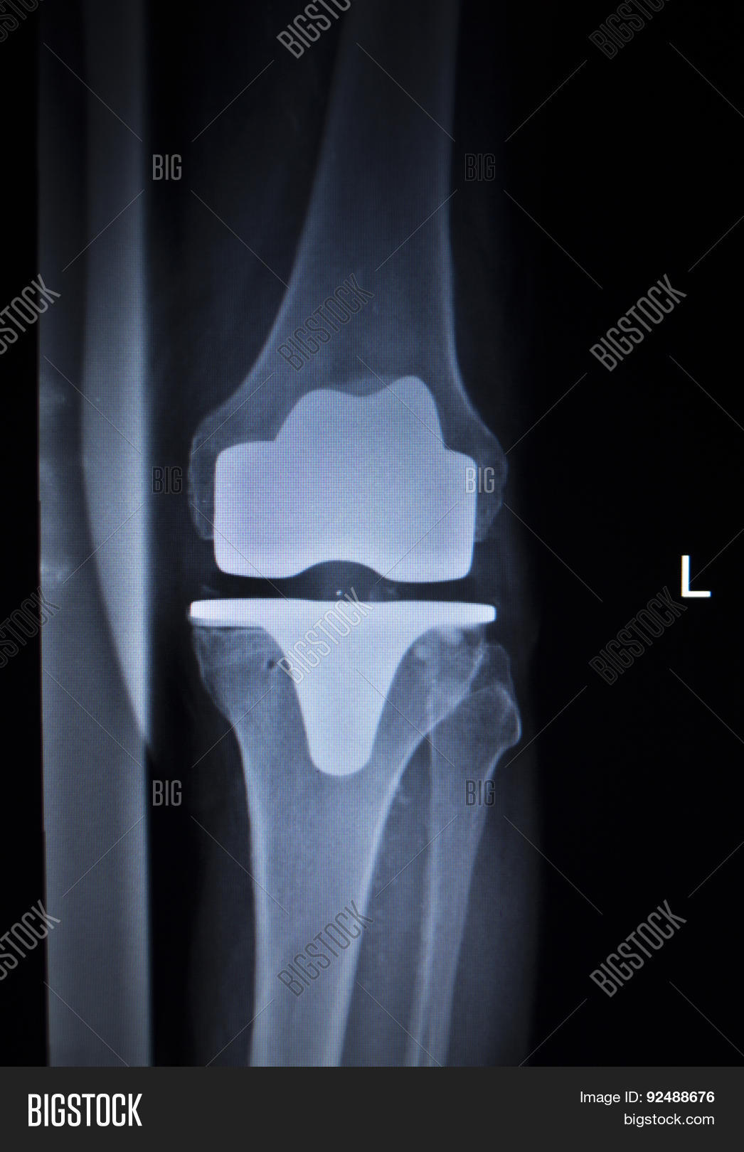 X-ray Orthopedics Scan Image & Photo (Free Trial) | Bigstock
