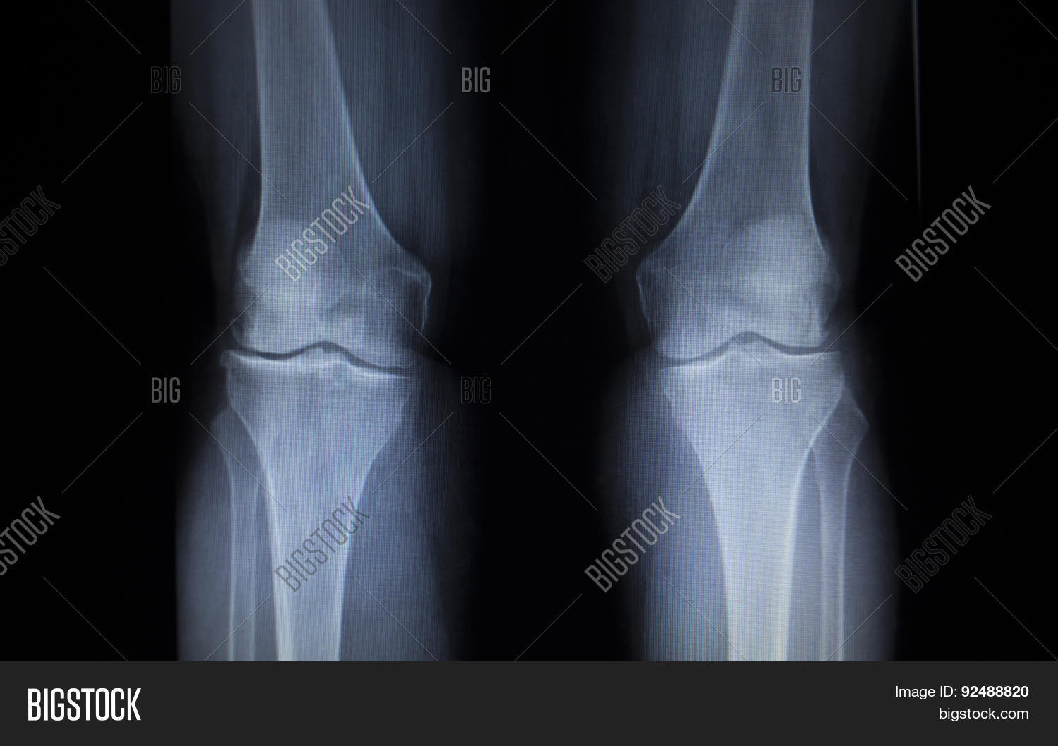 X-ray Orthopedics Scan Image & Photo (Free Trial) | Bigstock