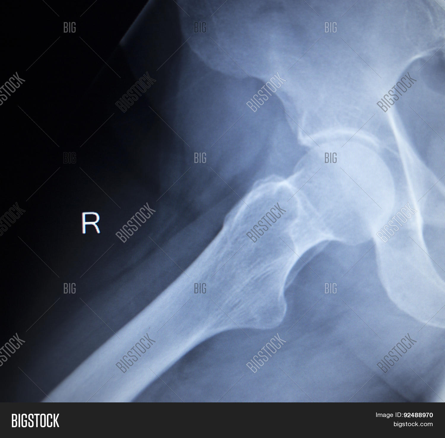 X-ray Orthopedic Scan Image & Photo (Free Trial) | Bigstock
