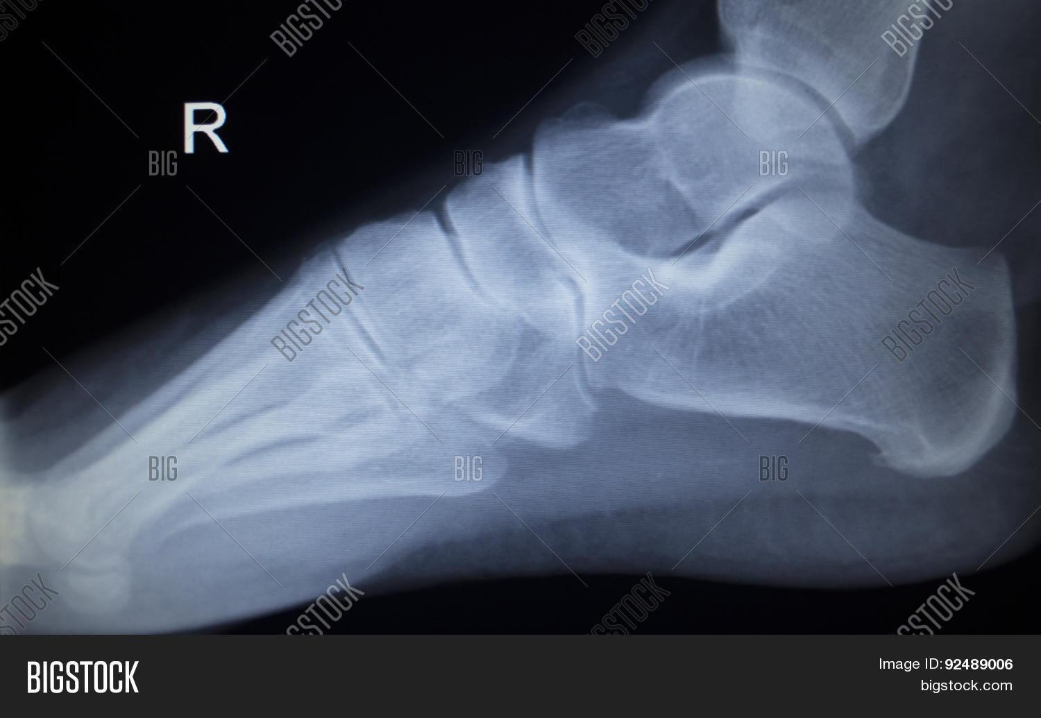 X Ray Orthopedics Scan Image And Photo Free Trial Bigstock