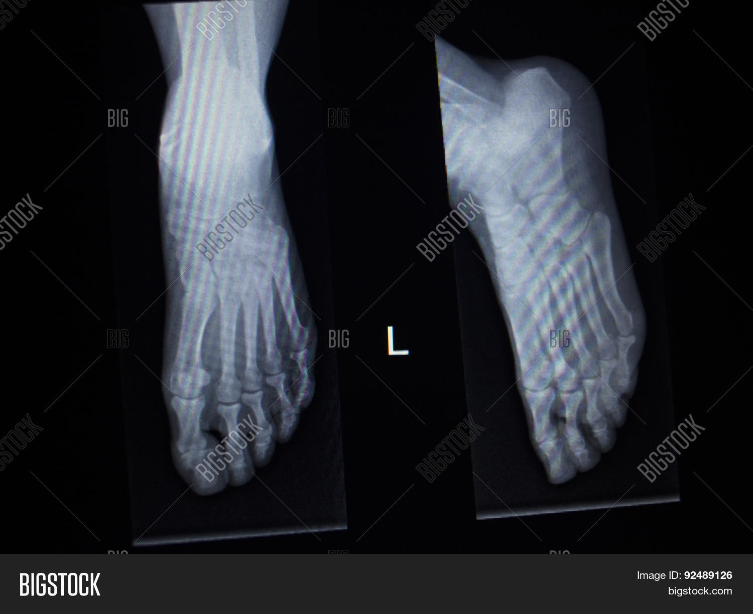X-ray Orthopedics Scan Image & Photo (Free Trial) | Bigstock