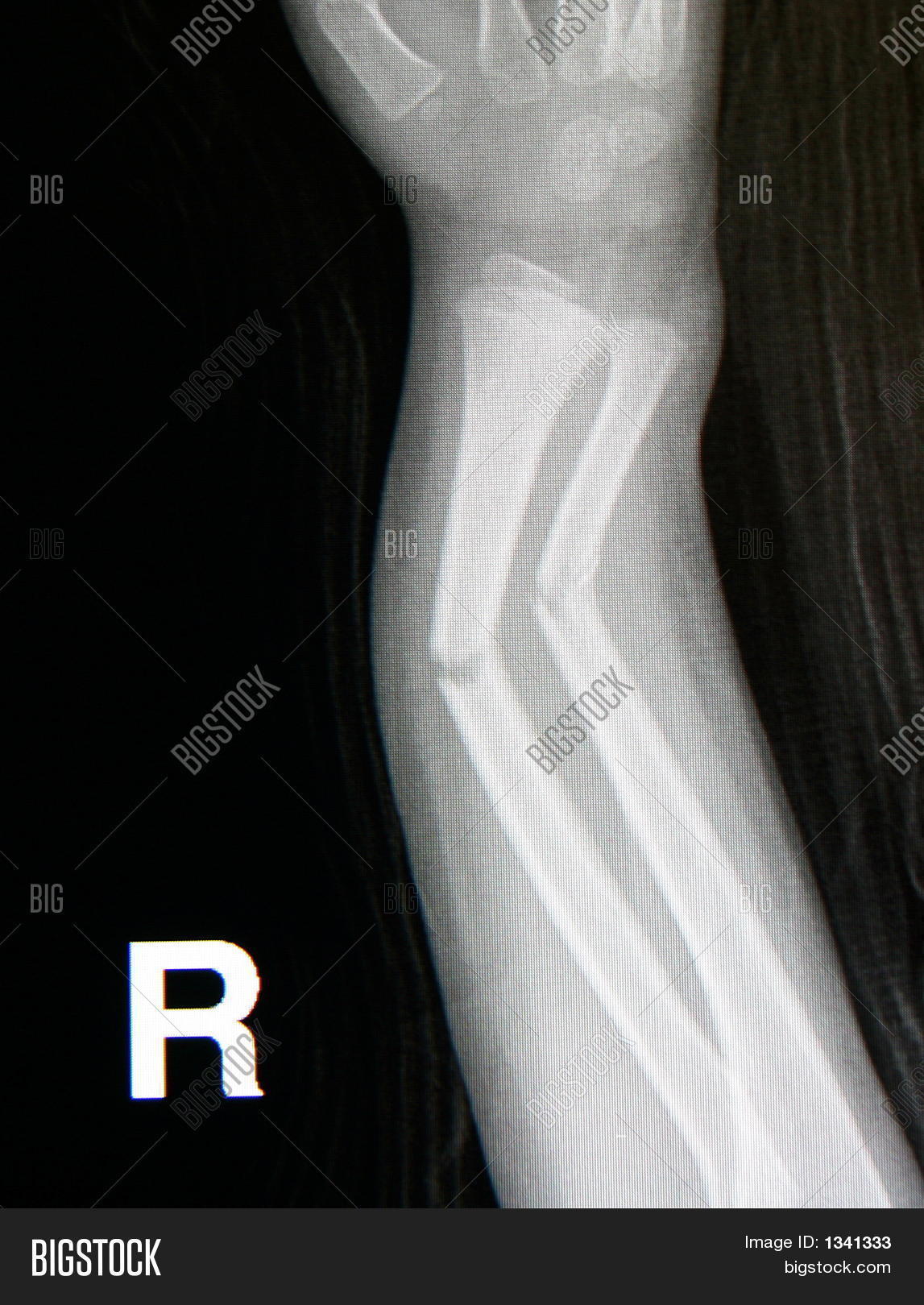 Right Forearm Fracture Image & Photo (Free Trial) | Bigstock