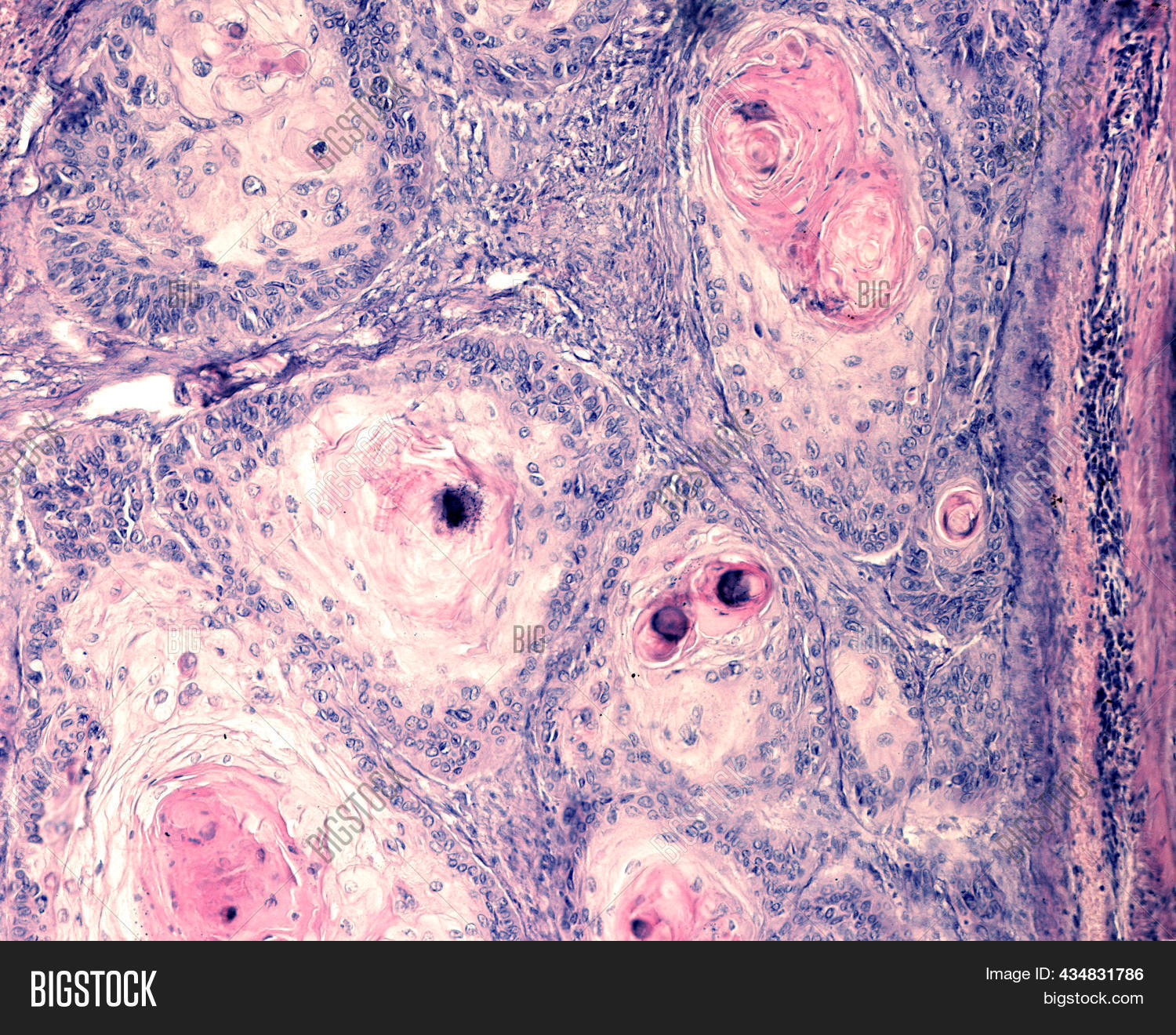 Squamous Cell Image & Photo (Free Trial) | Bigstock
