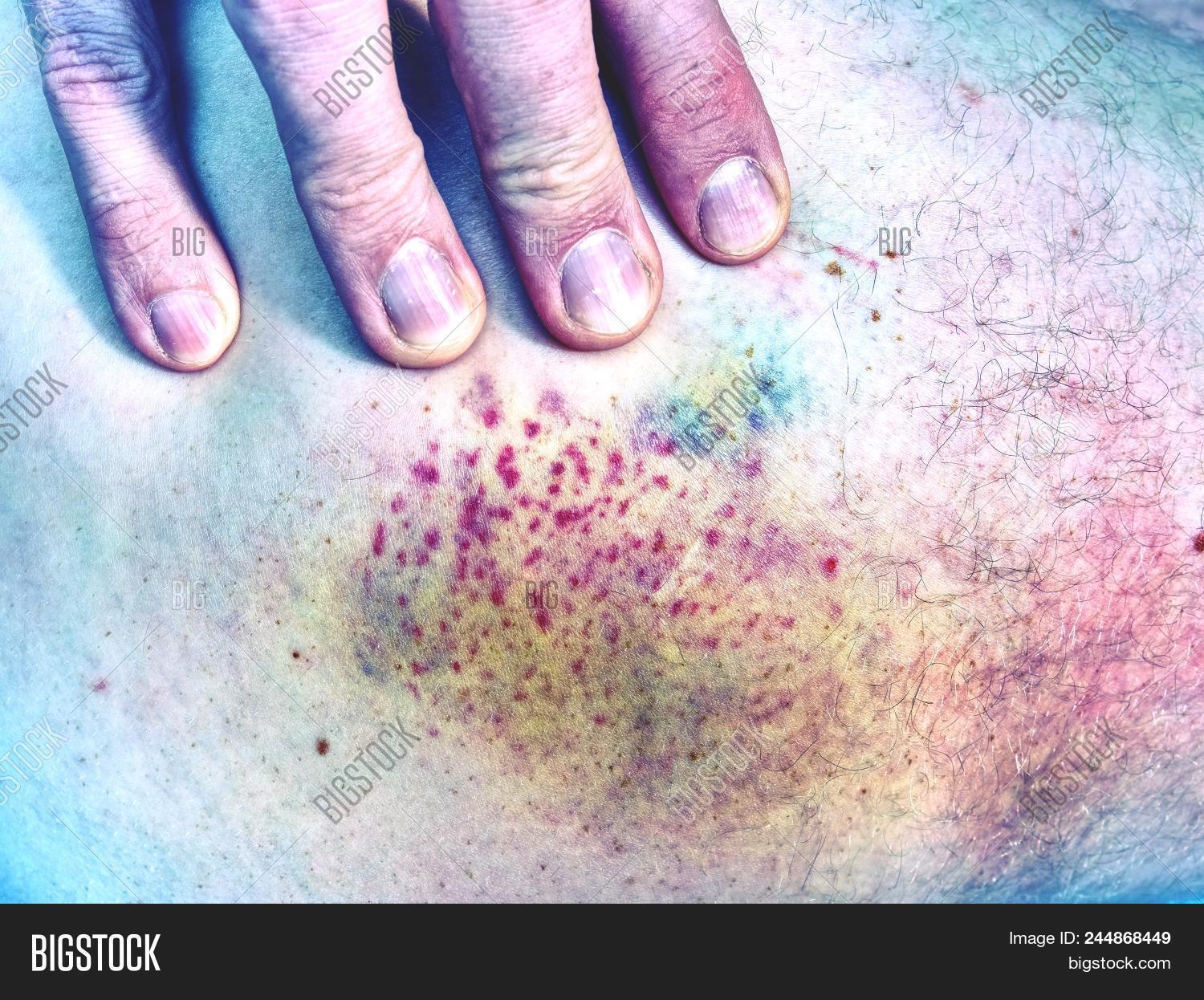Image et photo de Fresh Bruise On (essai gratuit) | Bigstock