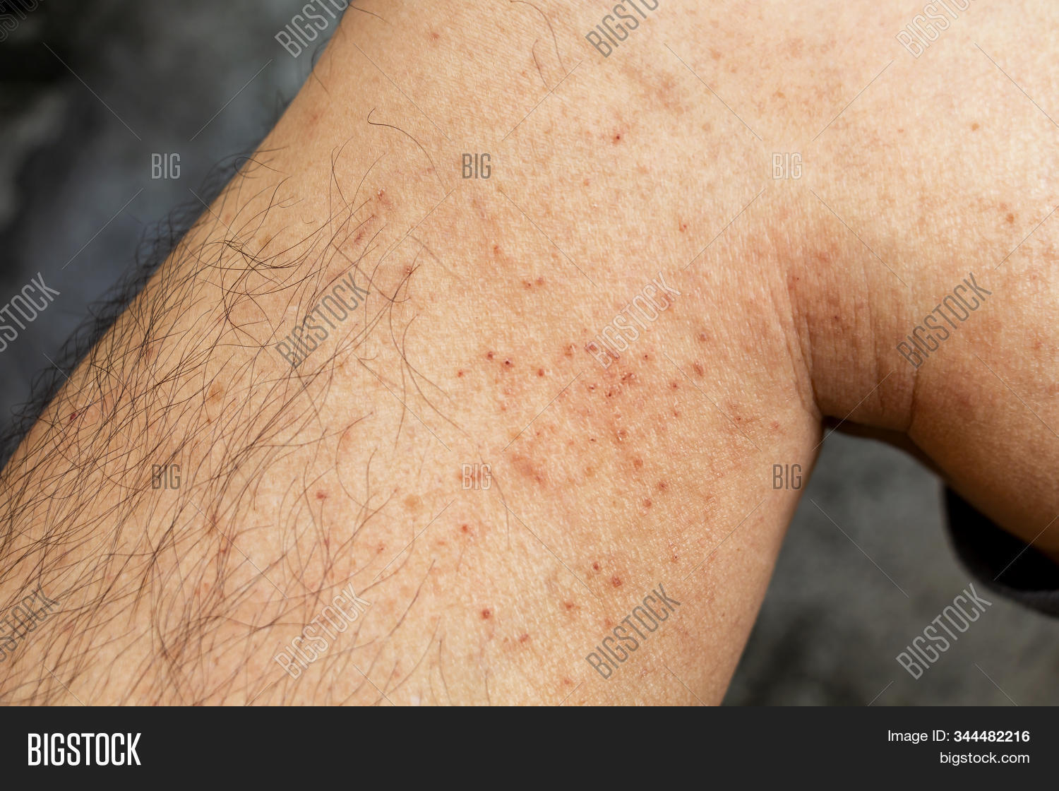 Skin Disease Winter. Image & Photo (Free Trial) | Bigstock