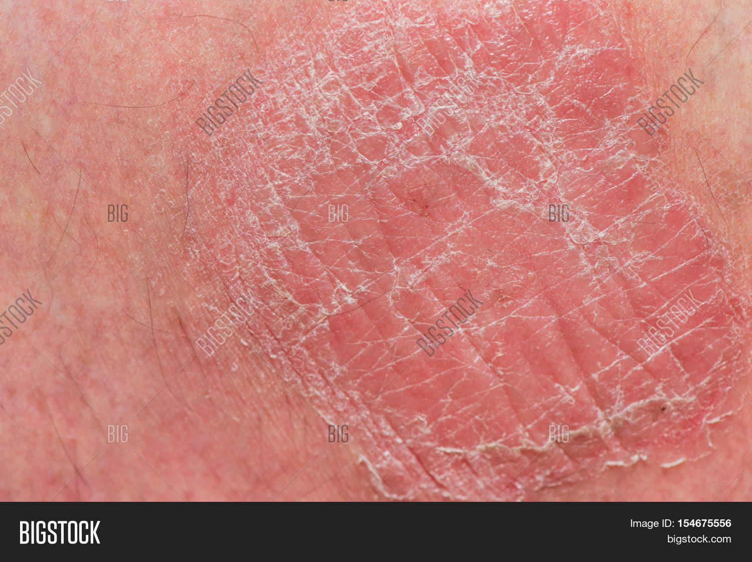 Psoriasis Skin. Image & Photo (Free Trial) | Bigstock