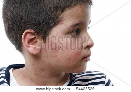 Urticaria On Face Image & Photo (Free Trial) | Bigstock