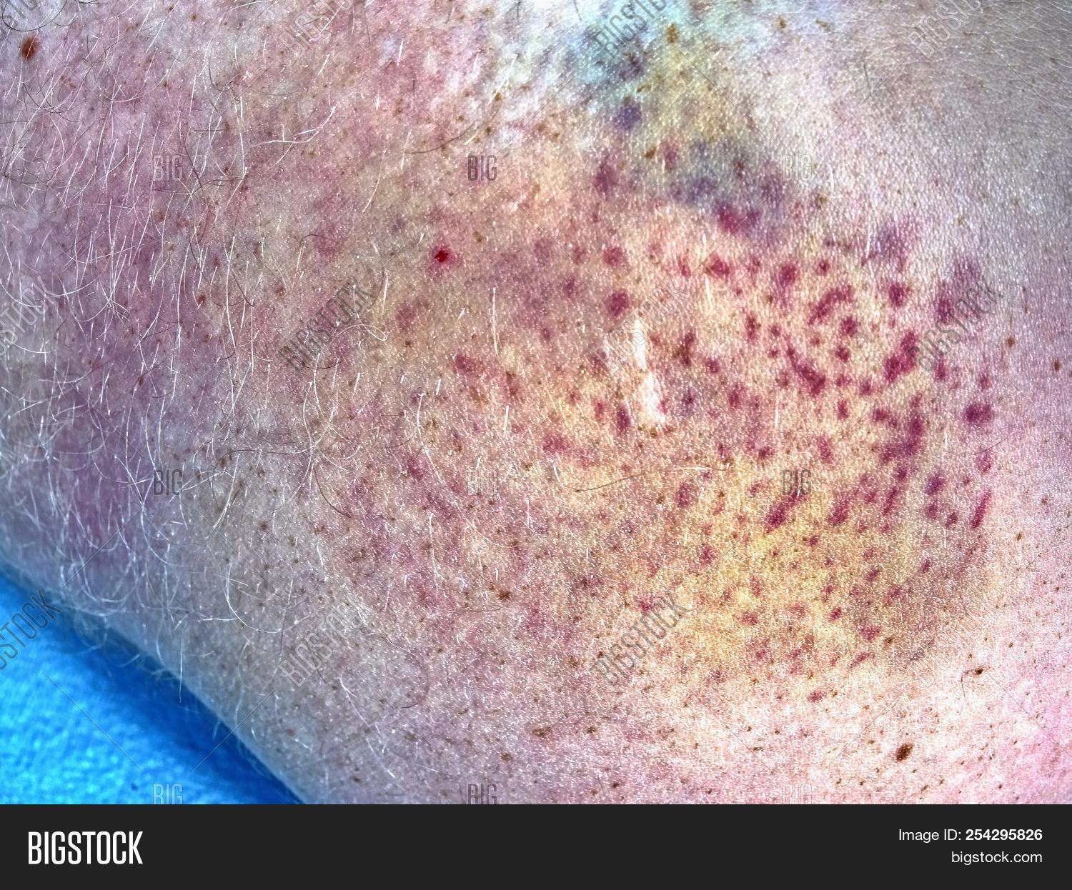 Large Colorful Bruise Image & Photo (Free Trial) | Bigstock