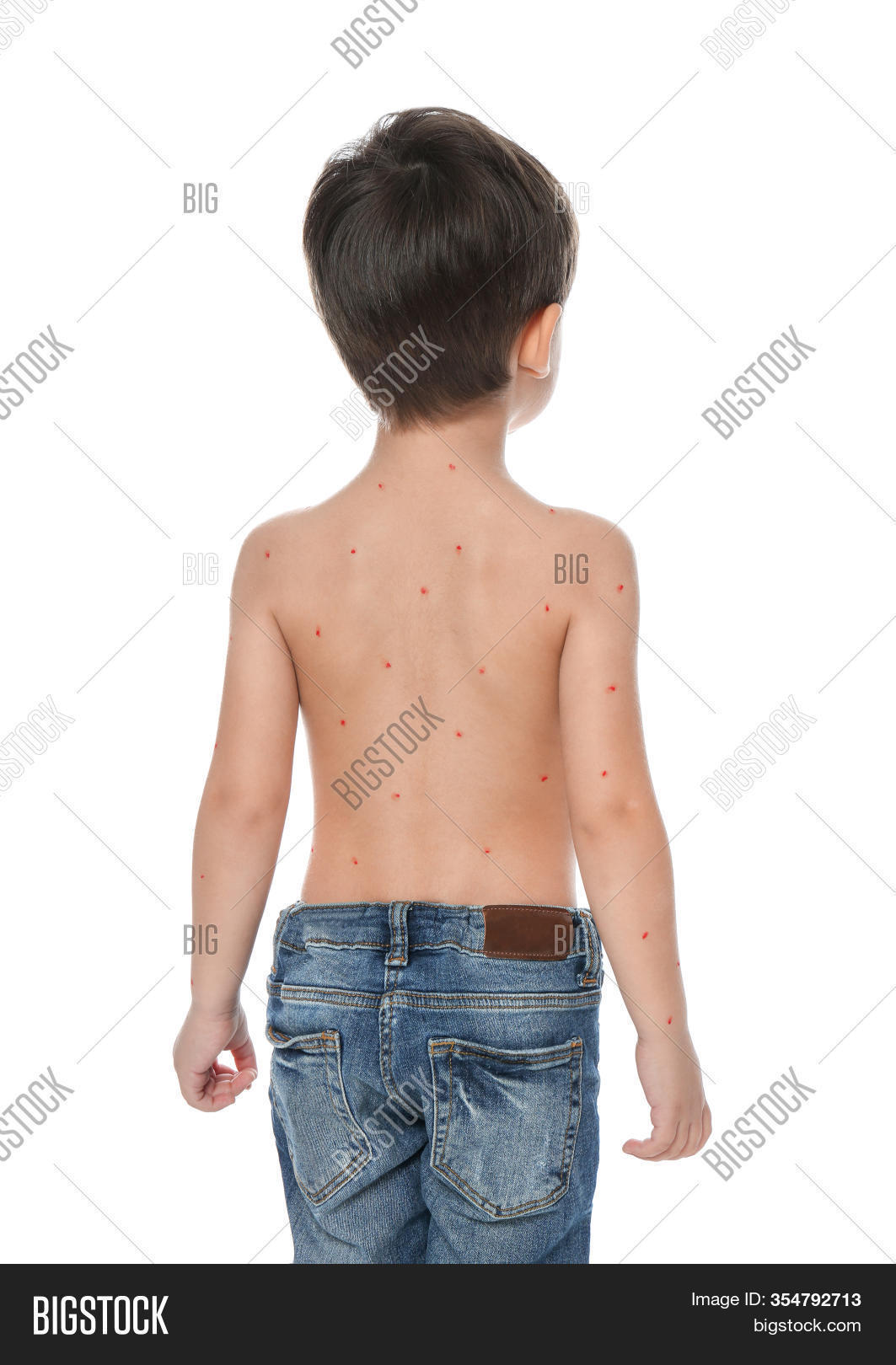 Little Boy Chickenpox Image & Photo (Free Trial) | Bigstock