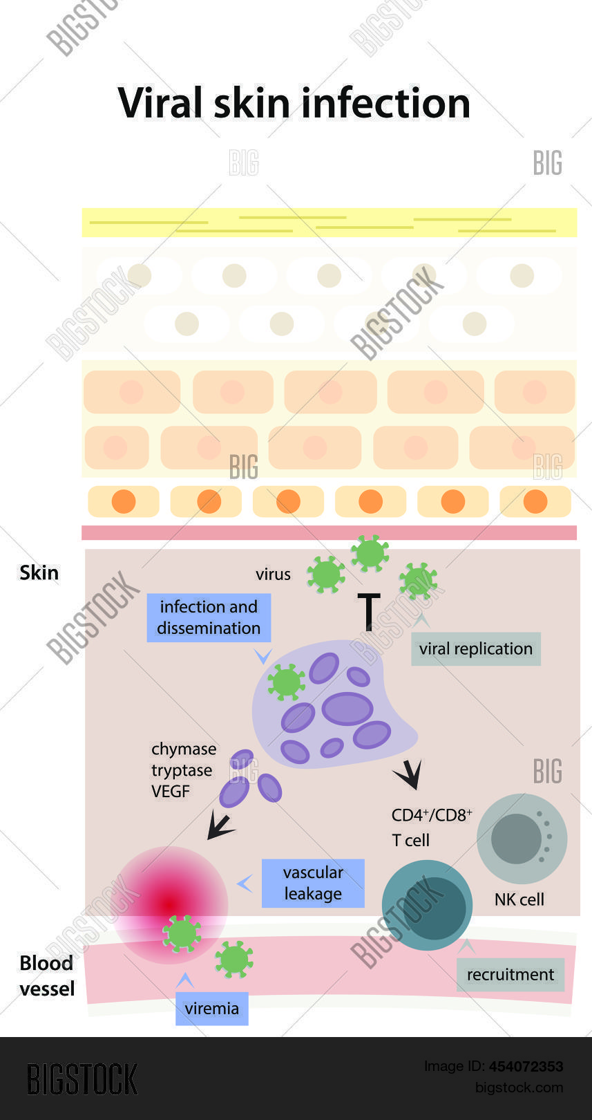 Viral Skin Infection Vector & Photo (Free Trial) | Bigstock
