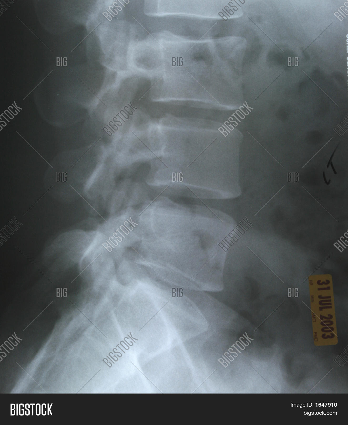 Lumbar Spine Spot Image & Photo (Free Trial) | Bigstock