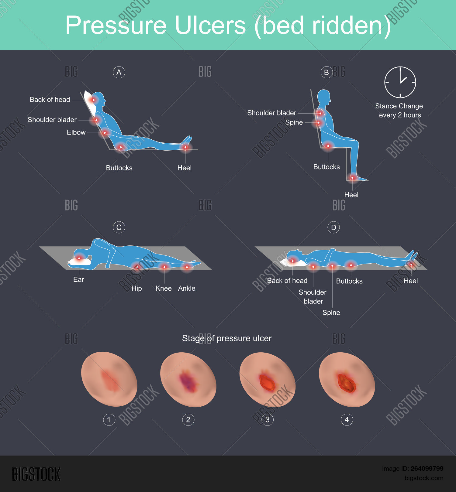 Pressure Ulcers Vector & Photo (Free Trial) | Bigstock
