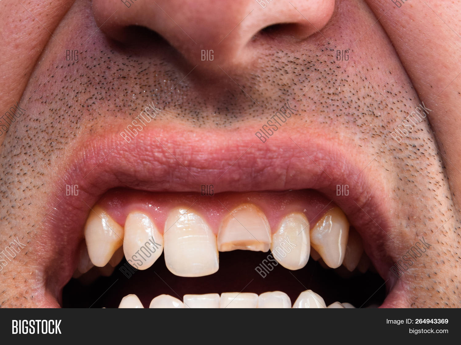 Broken Tooth. Broken Image & Photo (Free Trial) | Bigstock