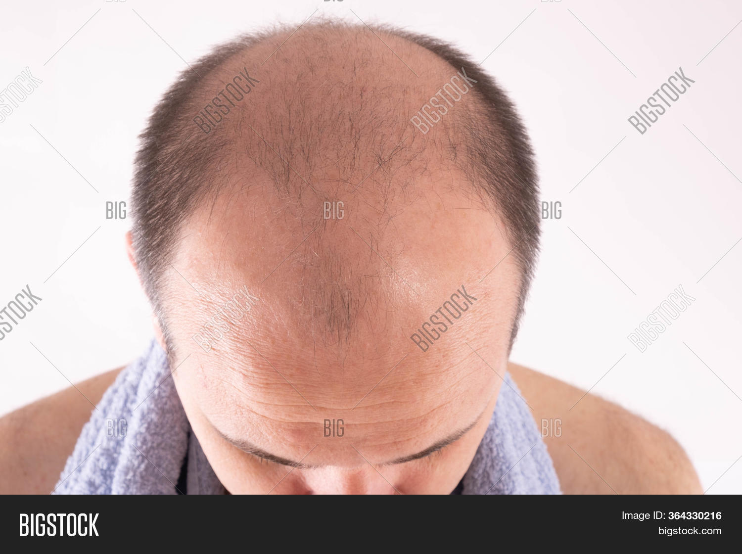 Male Head Sparse Hair Image & Photo (Free Trial) | Bigstock