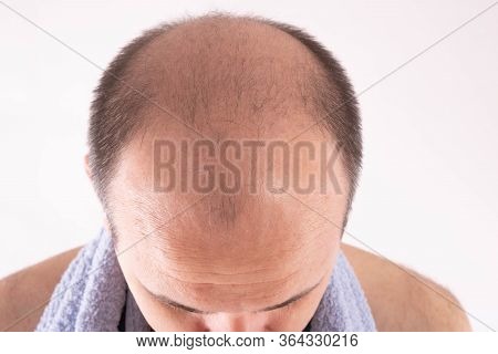 Male Head Sparse Hair Image & Photo (Free Trial) | Bigstock