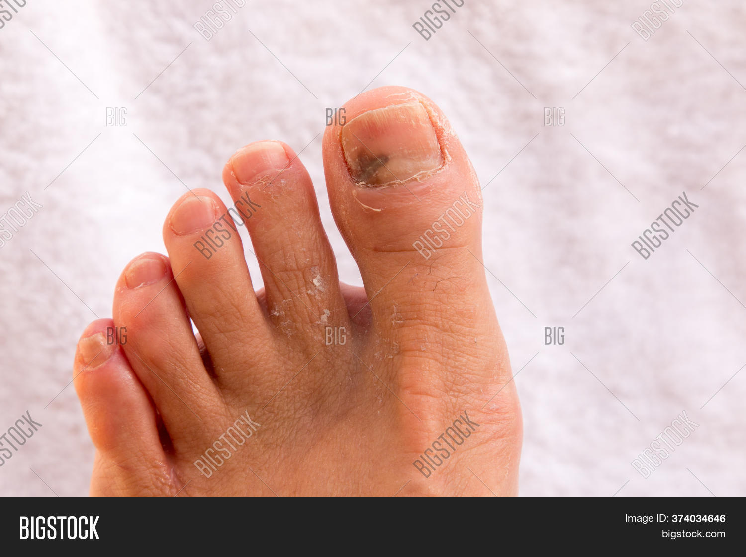 Big Toe That Broken Image & Photo (Free Trial) | Bigstock