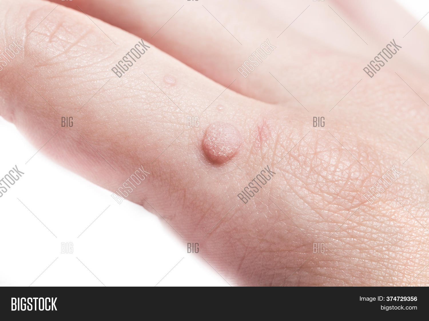 Common Wart Verruca Image & Photo (Free Trial) | Bigstock