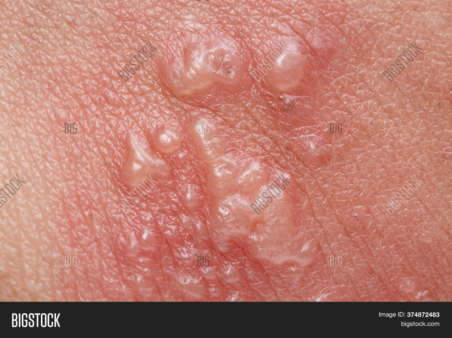Shingles, Zoster Image & Photo (Free Trial) | Bigstock