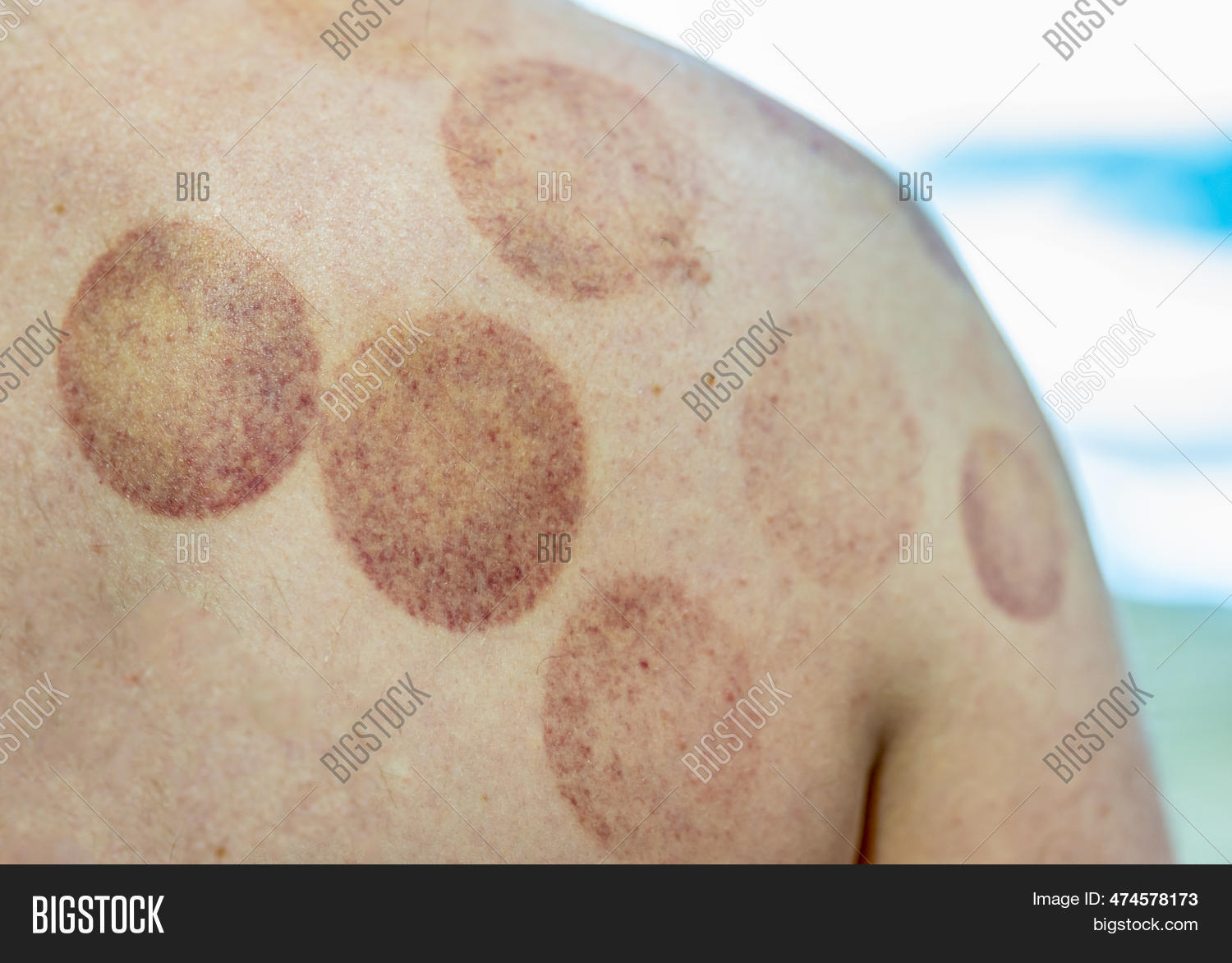 Circular Bruises On Image & Photo (Free Trial) | Bigstock